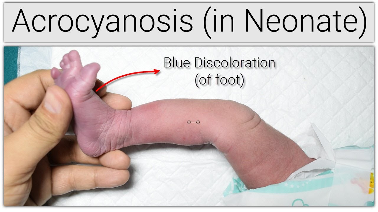 Acrocyanosis