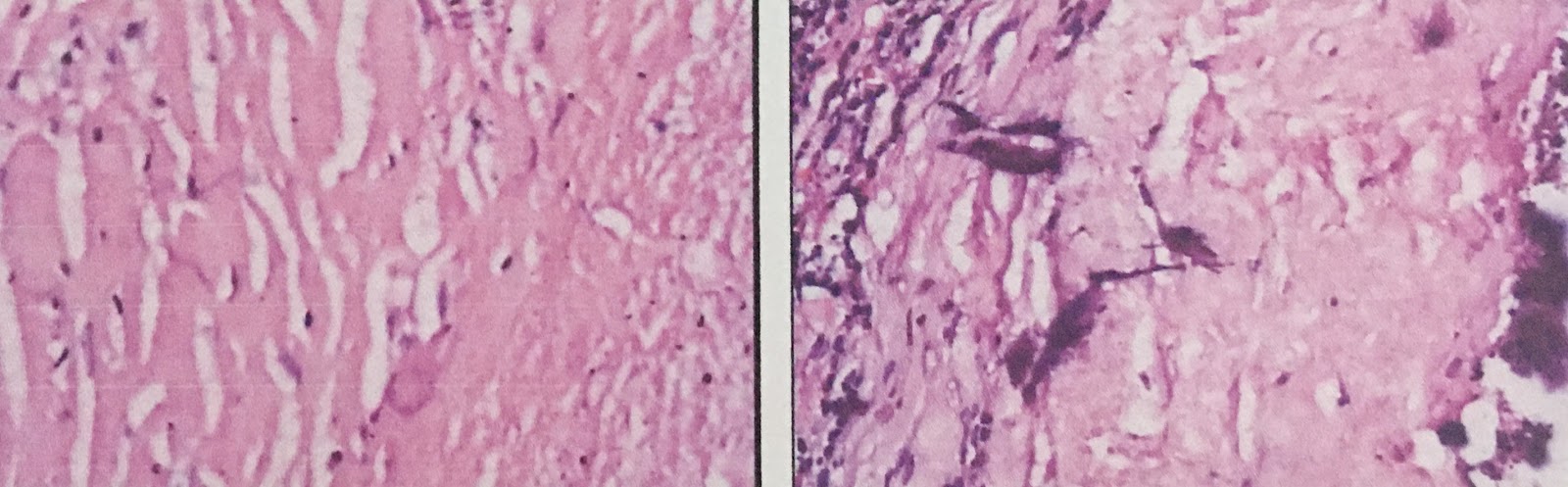 VIETNAMESE MEDIC ULTRASOUND: CASE 589: TB OF TESTIS, Dr PHAN THANH HẢI ...