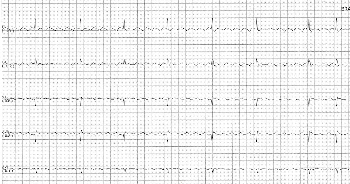 Atrial flutter