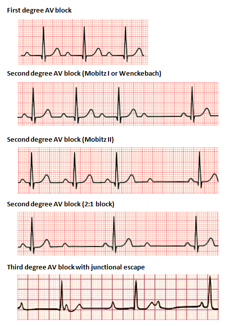 EKG TEMEL BİLGİLER, BRADİKARDİ, AV BLOKLAR