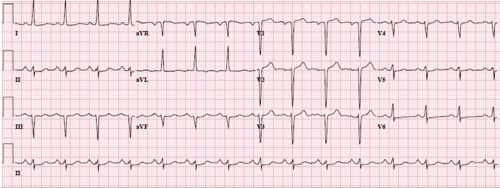 Dr. Smith's ECG Blog: LVH with anterior ST Elevation. When is it ...