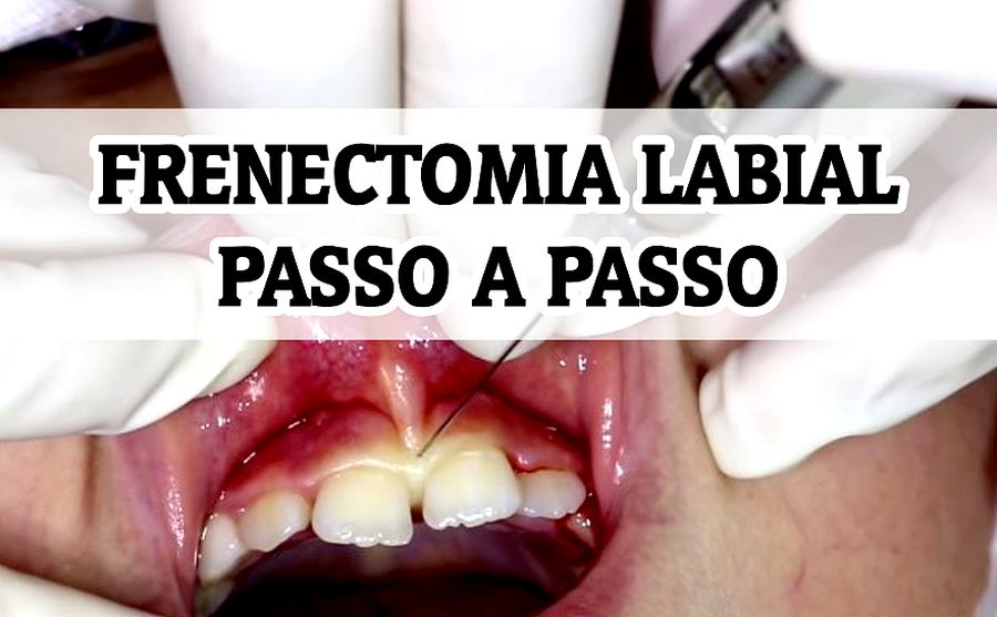 FRENECTOMIA LABIAL Superior Passo a Passo - Fernando Giovanella
