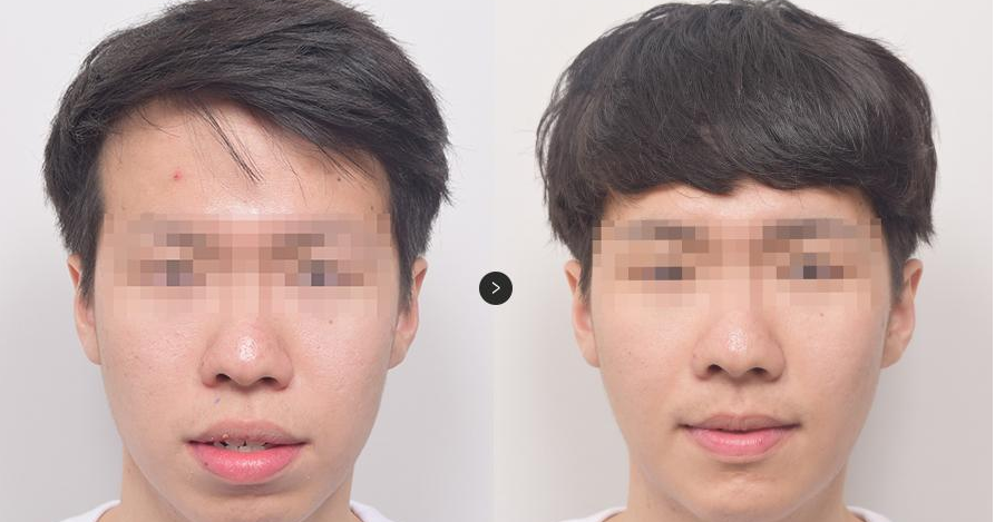 Want to achieve ideal face shape (Protruded mouth, jaw correction ...