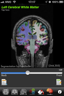 iSurf Brainview: Repaso de neuroanatomía a través de RM - probando