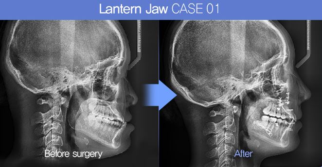 DA Smile Double Jaw Surgery by Cases