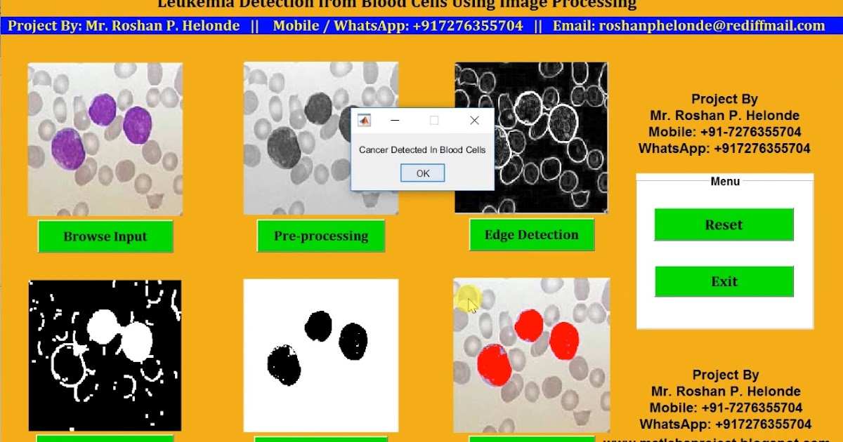 Matlab Code for Blood Cancer Detection using Image Processing ~ Low ...