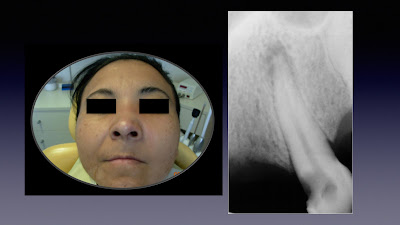 SECCION PARA ALUMNOS ENDODONCIA II : DIAGNOSTICO: ABSCESO ALVEOLAR AGUDO