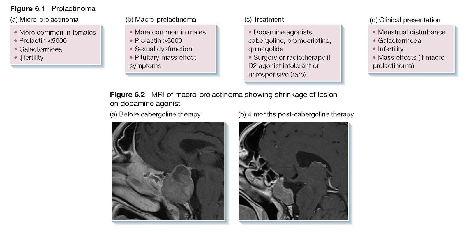 Prolactinoma and Hyperprolactinaemia - pediagenosis