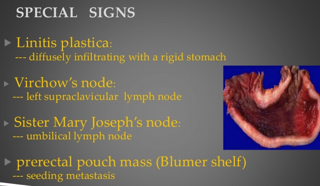 Special Signs of Gastric cancer.