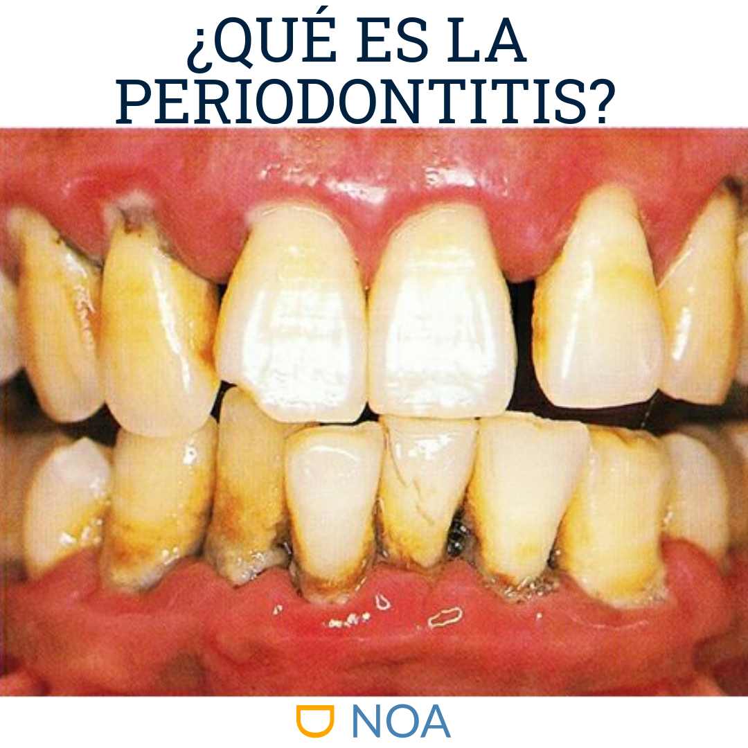 ¿QUE ES LA PERIODONTITIS?