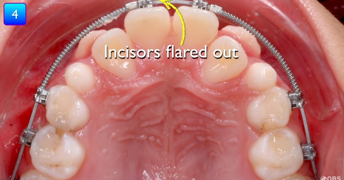 ORTHODONTICS: Bilaterally U2-U3 Transposition in Early mixed Dentitons ...