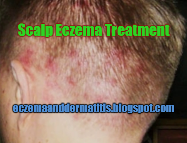Scalp Eczema Treatment - Eczema and Dermatitis