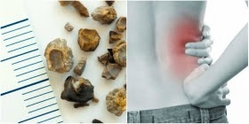 Qu'est-ce qui cause les pierres au reins ~ Nos Conseils de Vie