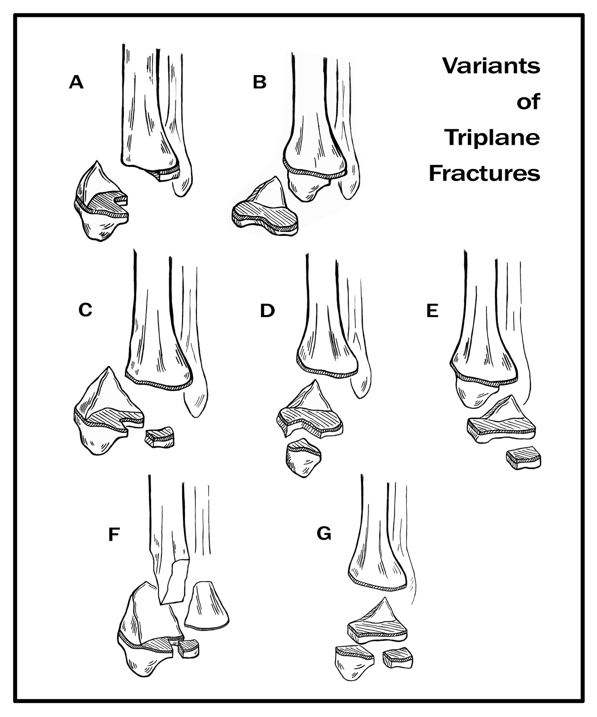 Triplane Orthobullets Fractures Sketch Coloring Page