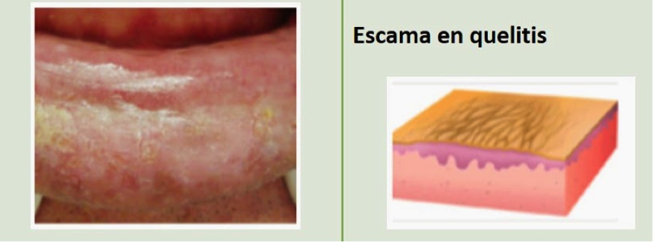 analauu19: Lesiones Elementales