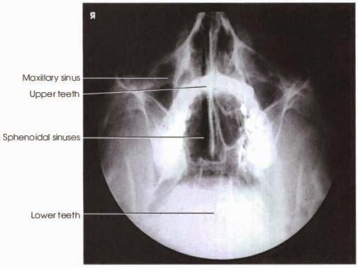 PARIETOACANTIAL TRANSORAL PROJECTION : SINUSES - RadTechOnDuty