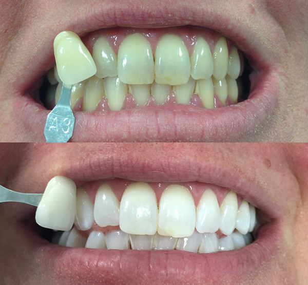 Conseils et habitudes à adopter pour bien prendre soin de l'émail dentaire