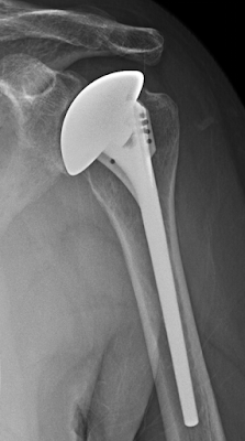 UW Shoulder and Elbow Academy: Ream and Run - state of the art