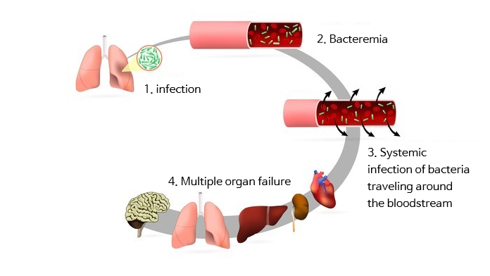 Sepsis - A sudden attack by bacteria