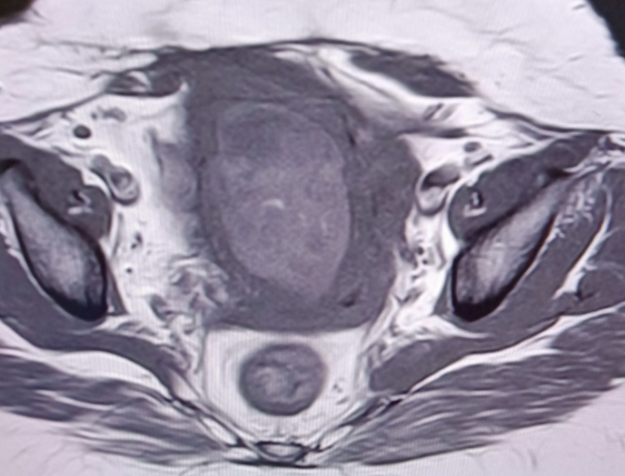 Cesarean scar ectopic pregnancy- MRI - Sumer's Radiology Blog