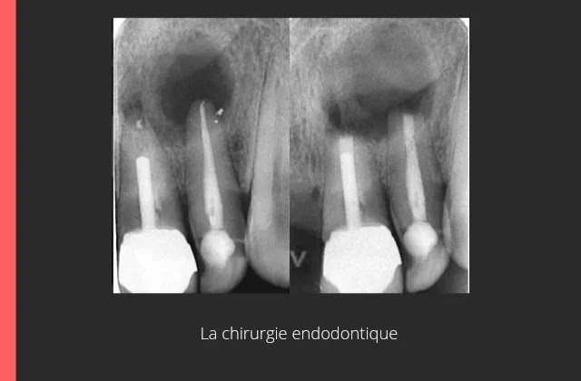 La chirurgie endodontique - MEGA dentist