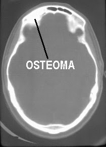 Osteoma: Osteoma