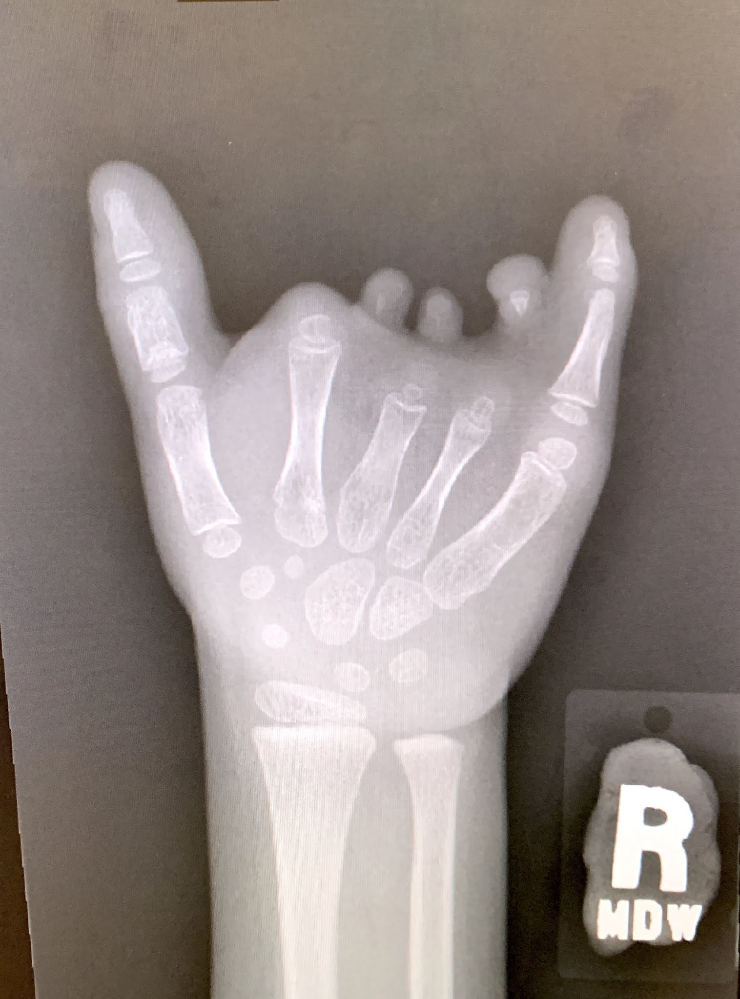 2 Common Types of an Uncommon Condition- Symbrachydactyly | Congenital ...