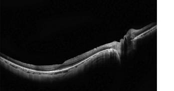 Atlas of Retinal Oct E-Book: Optical Coherence Tomography 2017