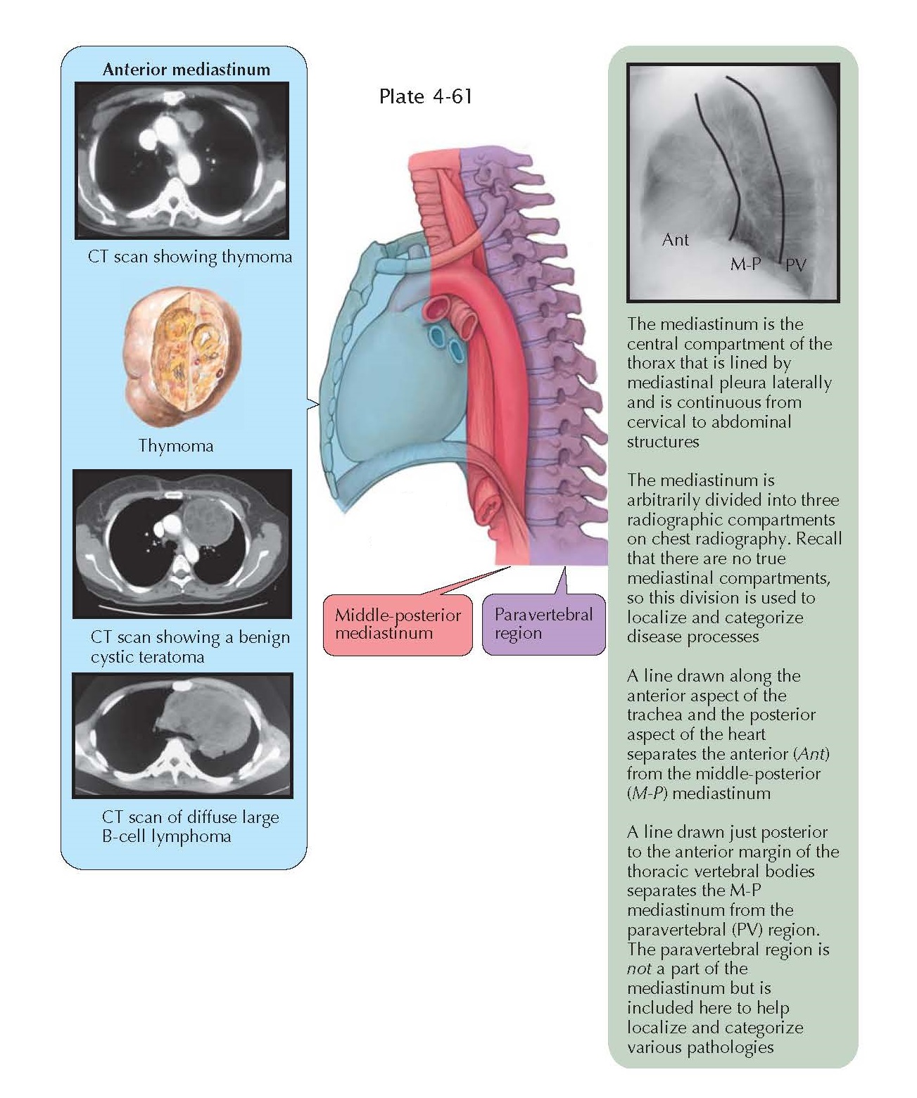 MEDIASTINAL TUMORS: ANTERIOR MEDIASTINUM - pediagenosis