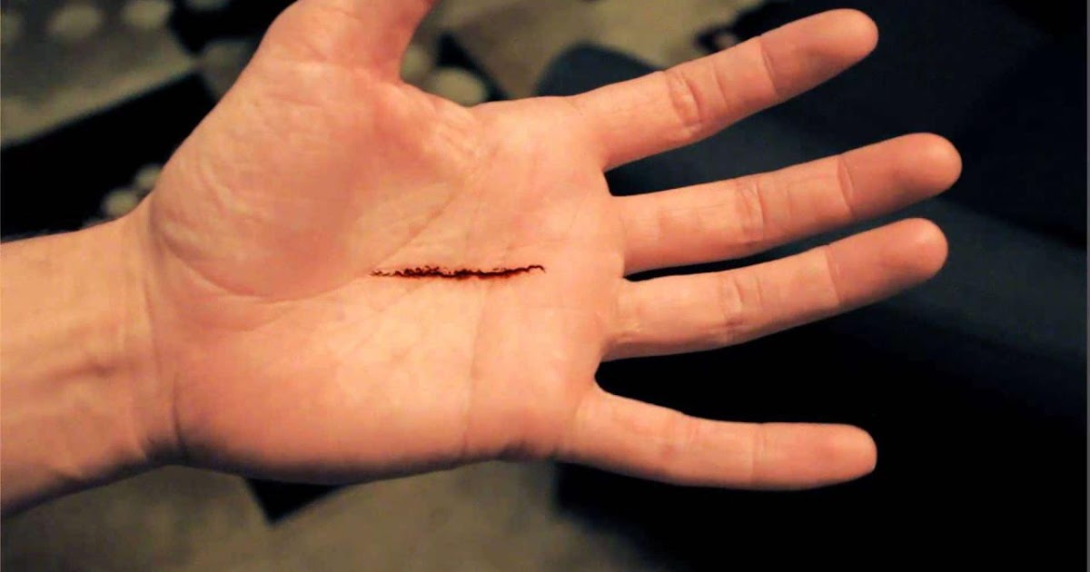 صور ايد متعورة - صور يد مجروحه