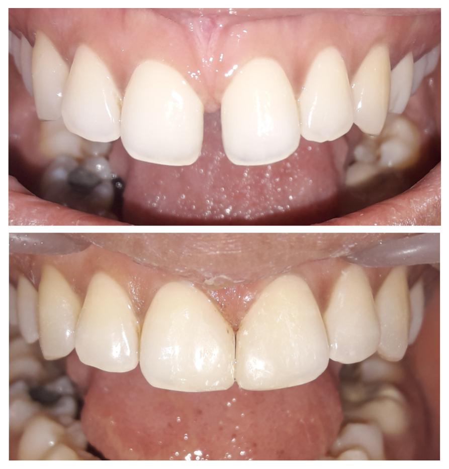 Tooth space closure - THE DENTAL EXCELLENCE