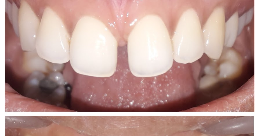 Tooth space closure - THE DENTAL EXCELLENCE