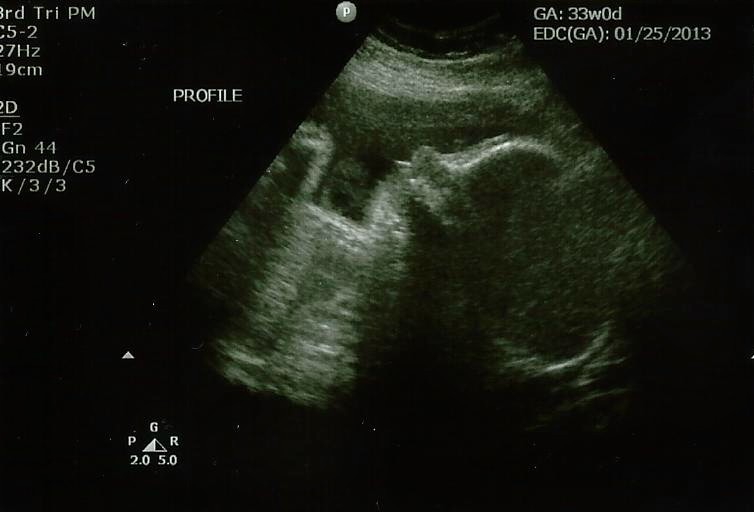 The Main Page: 33 Week Ultrasound
