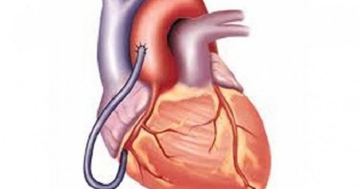 Bekam Surabaya | Klinik Terapi Bekam Panggilan NHT: Mengetahui Beberapa ...