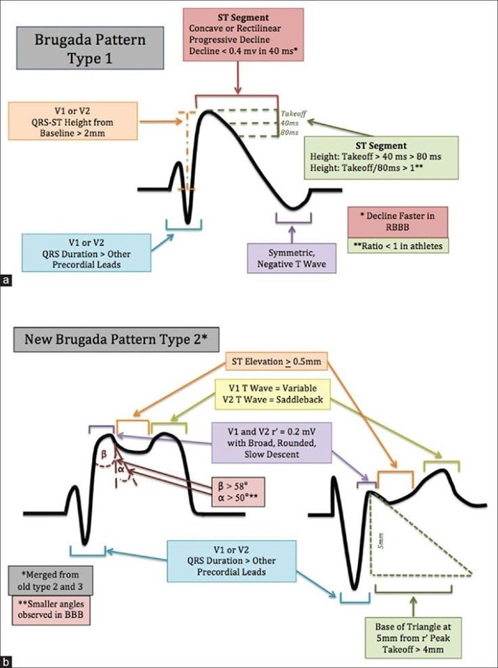 Curso de Lectura Electrocardiografica Veloz: Arritmias