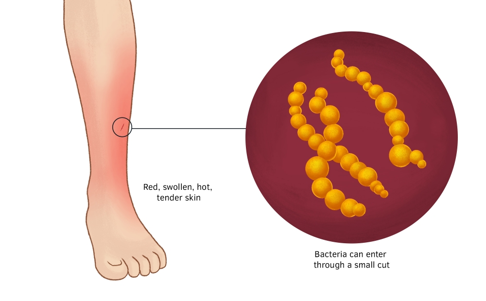 CELLULITIS - Medical Yukti