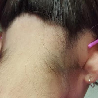 Alopecia Areata