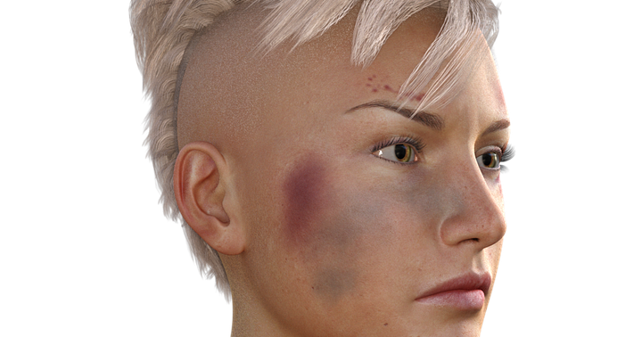 Luka Lebam, Dikompres Dengan Es Atau Air Hangat? - MITRA EDUKASI