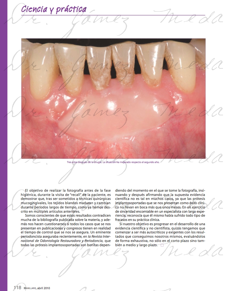 Dr.Meda: Injerto Epitelial Libre: Control de la Estabilidad a Largo ...