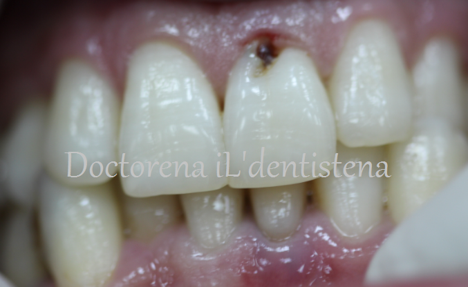 My Dental Diary: Class V restoration - Operative