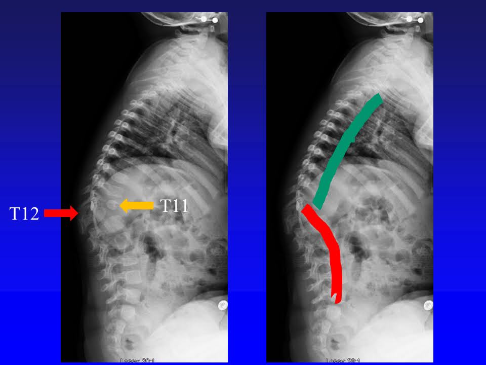 Congenital Spine Dislocation | Growing Spine Blog | Washington ...