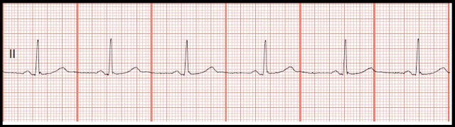 Practice EKG Rhythm Strips 145