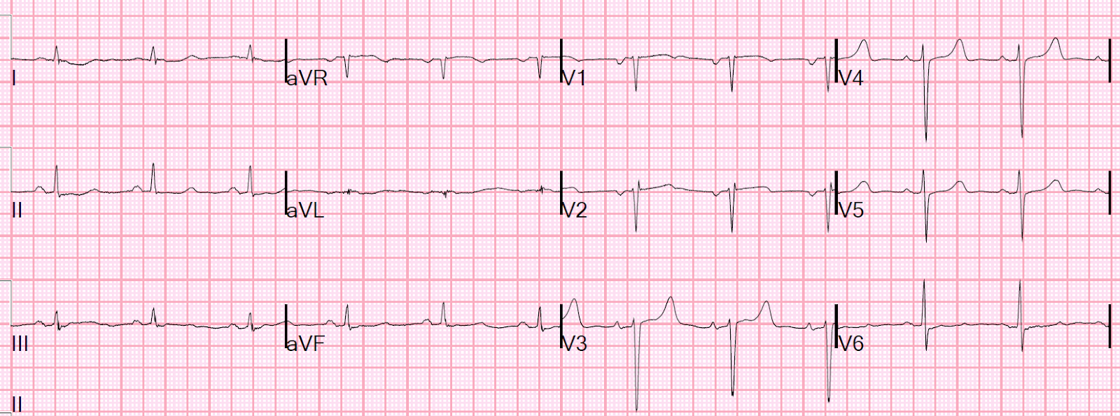 Dr. Smith's ECG Blog: I saw this computer "normal" ECG in a stack of ...