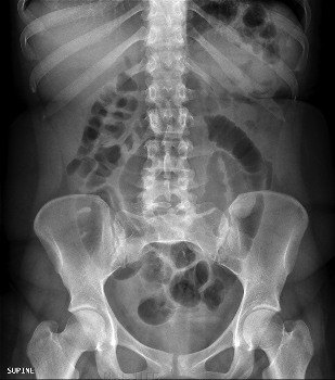 Estudo Radiográfico : ROTINA DE ABDOME SIMPLES