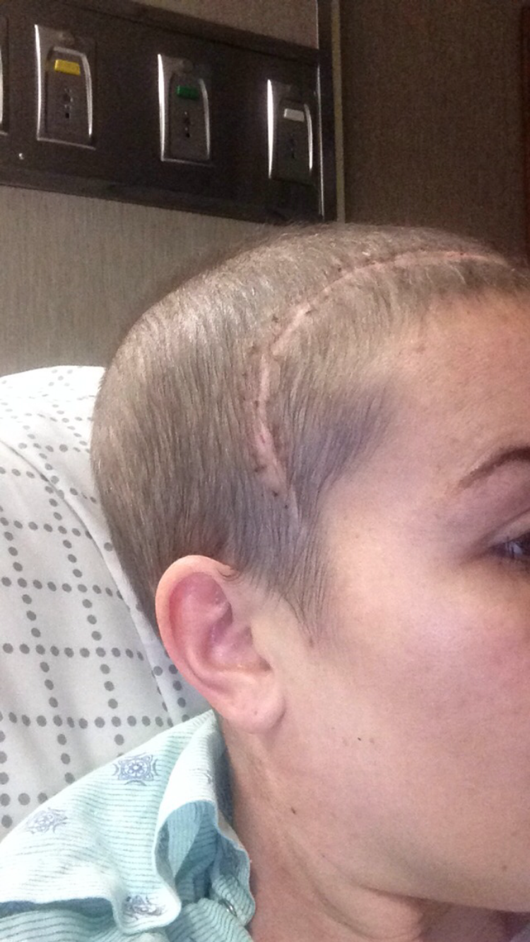 Val vs. Cancer: My battle against a rare brain tumor: Scars, meds and ...