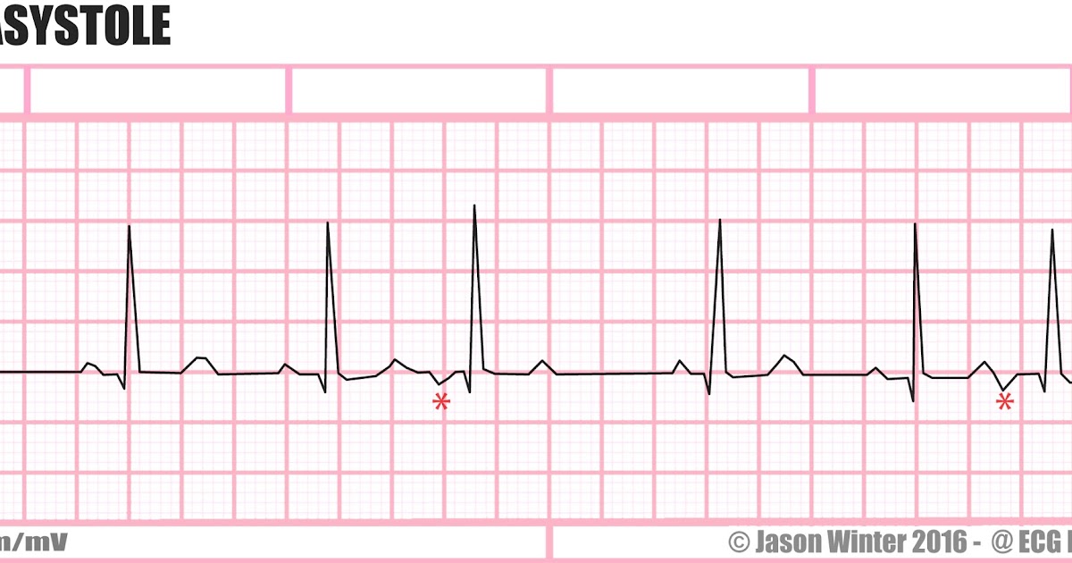 ECG Educator Blog : Parasystole