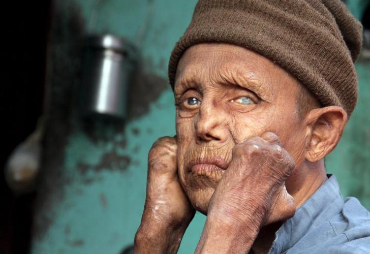 Ciri-Ciri Penyakit Lepra Atau Kusta