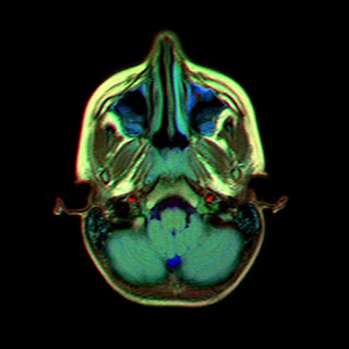 Nevit's blog: Color MRI of the Brain