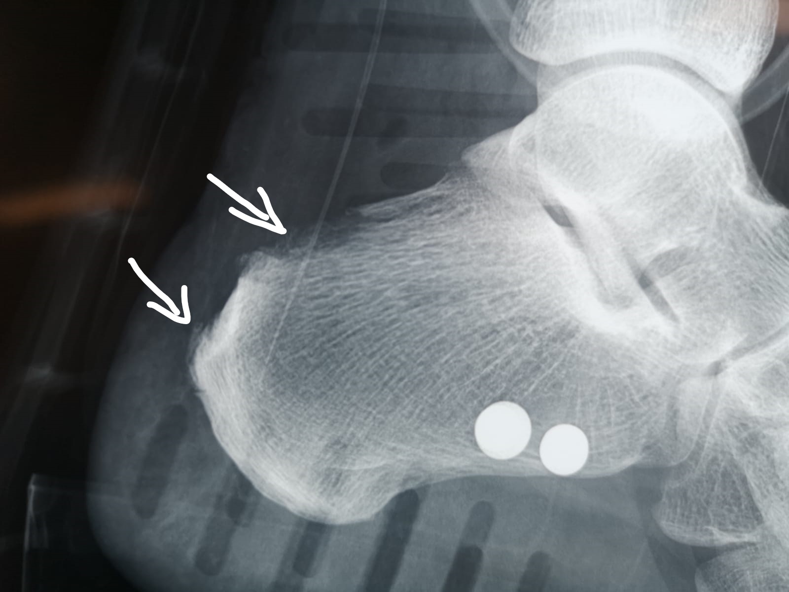 Sportul, si ce face el din calcaiele noastre! Cu sau fara maladia Haglund