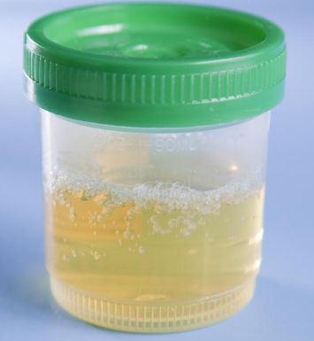 Kidney Disease und hoher Kreatinin